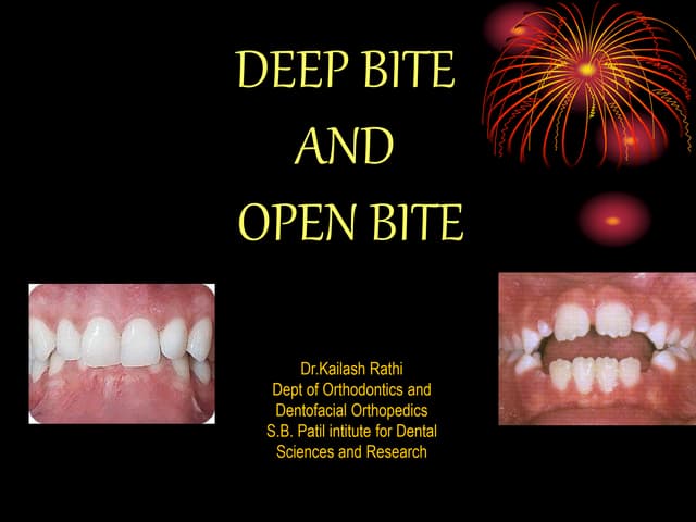 Anterior Open Bite | PPT