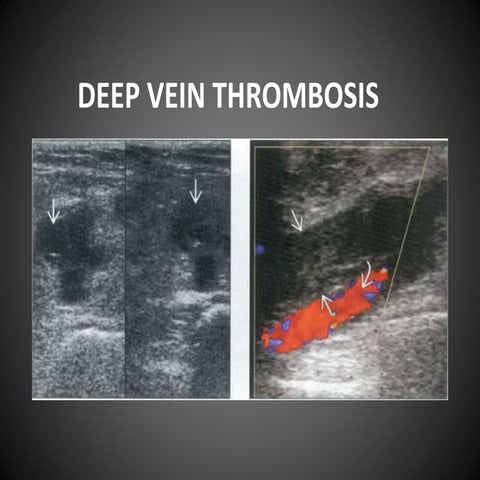 21 radiolucent metaphyseal bands | PPTX