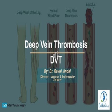 Deep Vein Thrombosis General Awareness | PPT