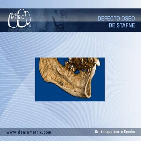 Defecto oseo de stafne | PPTX