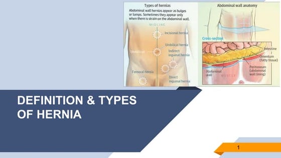 Inguinal Hernia- Groin Swellings | PPT