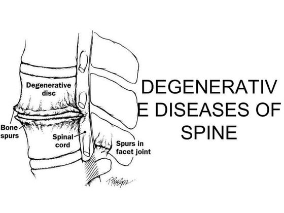 Abcs of the degenerative spine | PDF
