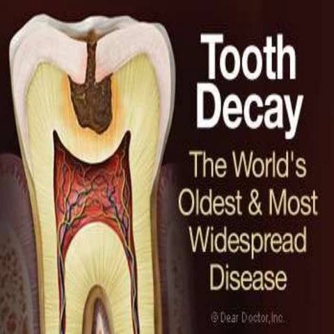 Zones of enamel and dentinal caries completed | PPTX