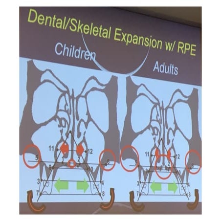 Non-Surgical Mid-Facial Expansion with Micro-Implant Assisted Maxillary ...