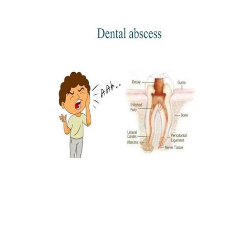 dental abscess lec.pdf
