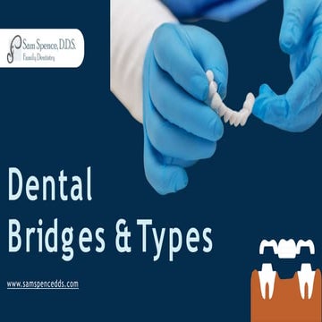 Dental Bridges And It's Types Explained Simply | PPTX