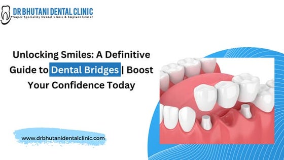 How Dental Bridges Can Restore Your Smile and Confidence? | PPT