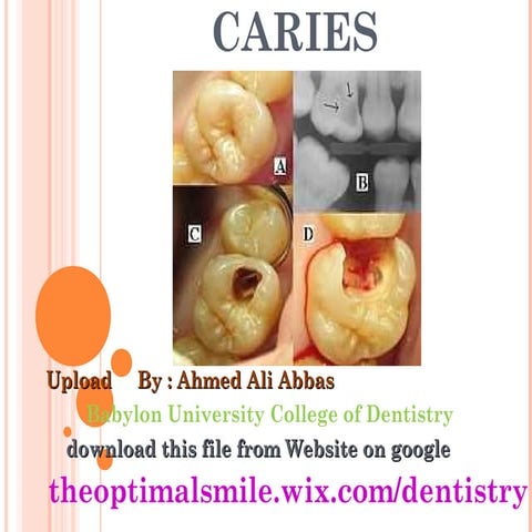 Dental caries | PPT