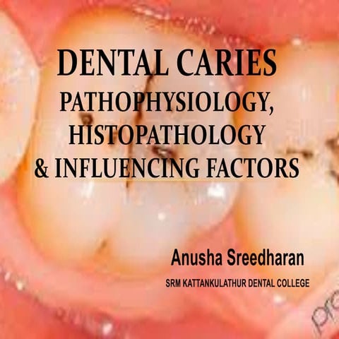 Dental caries | PPT