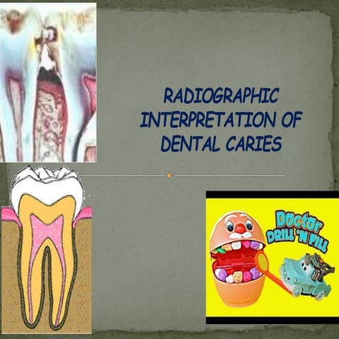 Radiographic assessment of dental caries | PPT