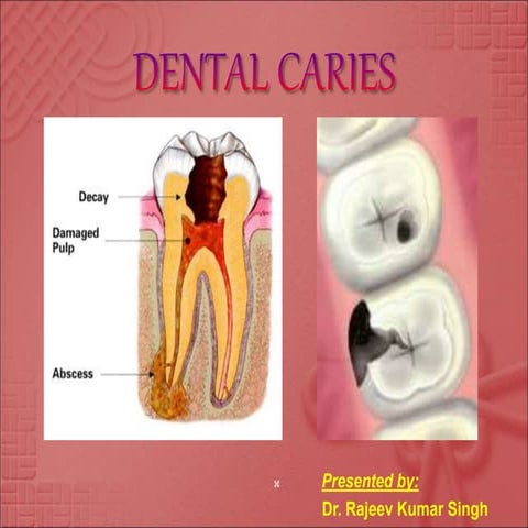Incipient caries | PPTX