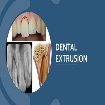 Tooth Extrusion