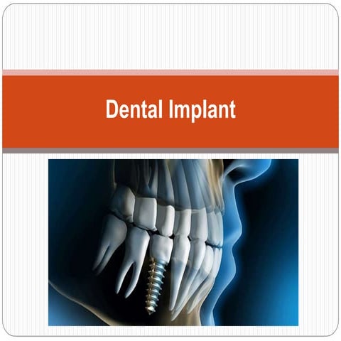 Dental implant | PPSX