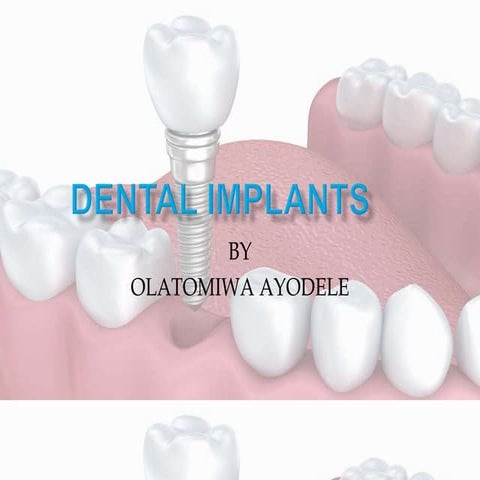 Dental implants | PPT