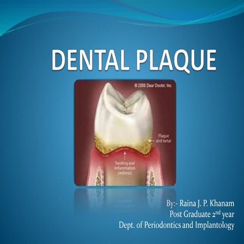 Dental plaque | PPTX