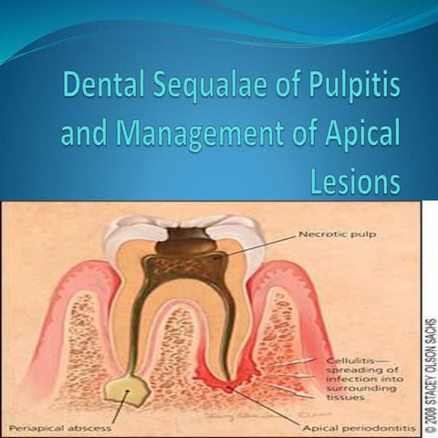 Dental sequalae of pulpitis and management of apical lesions | PPTX