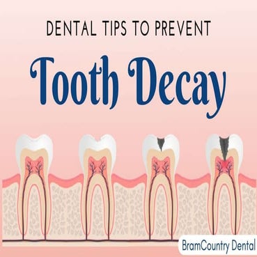 Dental Tips to Prevent Tooth Decay by the Dentist in Brampton | PPT
