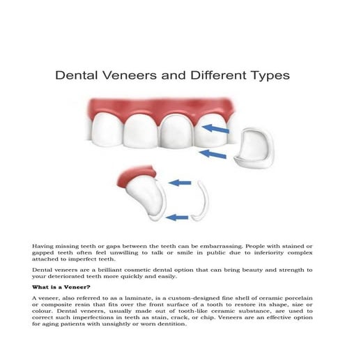 Dental veneers and different types | PDF