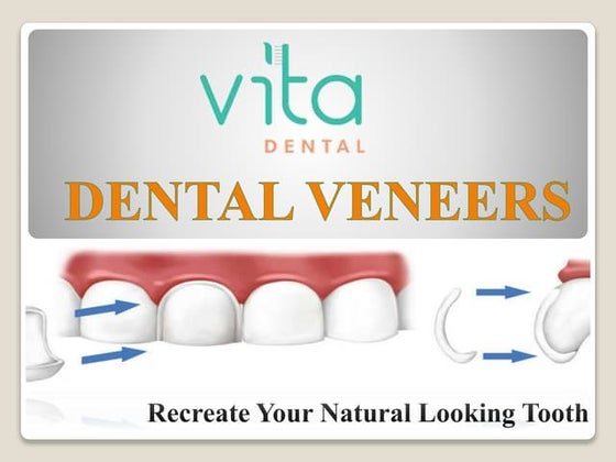 Veneers(1).pdf