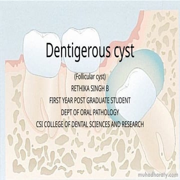 DENTIGEROUS CYST (FOLLICULAR CYST) PPT | PPTX