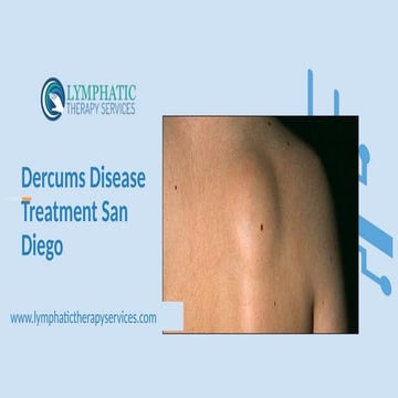 Dercums Disease Treatment San Diegopptx