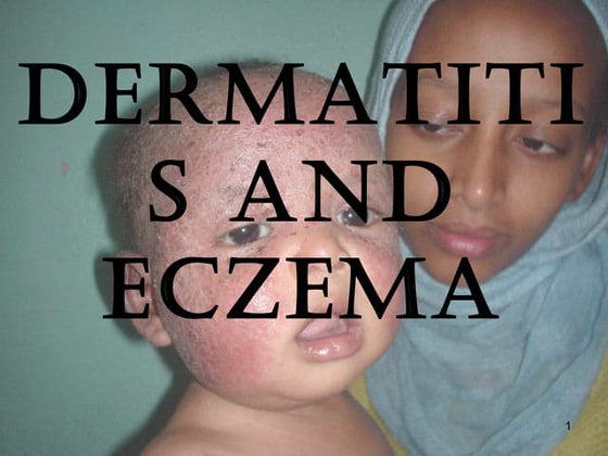 Atopic dermatitis. Presentation in pediatric case | PPT