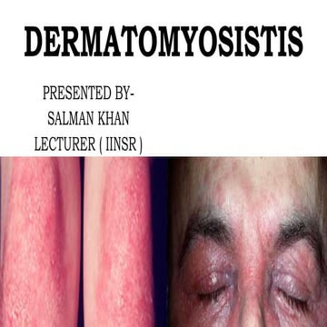 DERMATOMYOSITIS.pptx