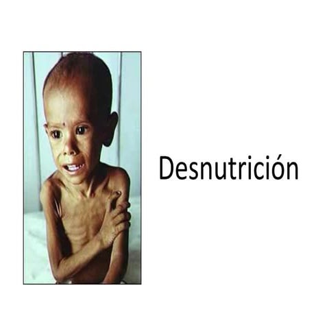 Desnutrición buena1.ppt