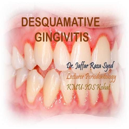 Desquamative Gingivitis and its management.pptx
