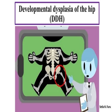 Developmental dysplasia of the hip (DDH).pptx