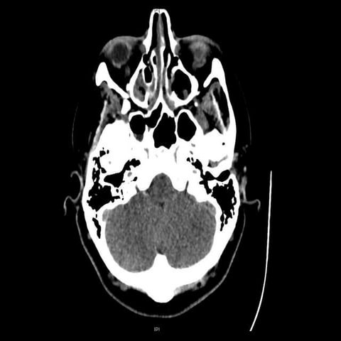 Hypoxic ischemic encephalopathy: Lecture on HIE | PPT