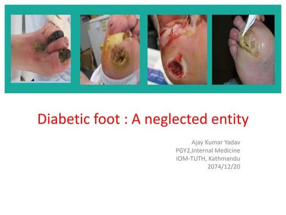 Leg Ulcer.pptx