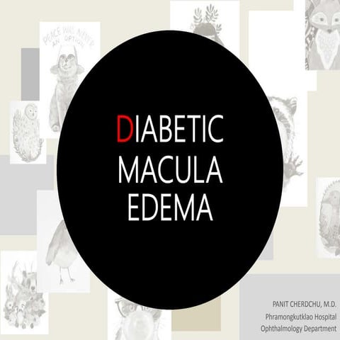 DIABETIC MACULAR EDEMA | DOCX
