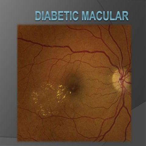 Diabetic macular edema | PPTX
