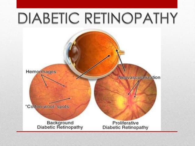 Diabetic Retinopathy- PDR and CSME | PPTX