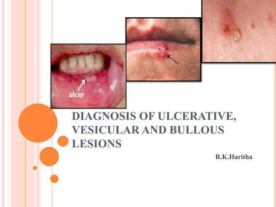 Oral ulcer revision 1 | PPT