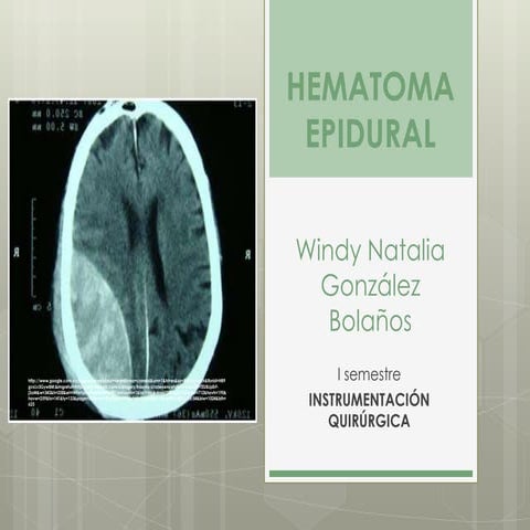 ABSCESO EPIDURAL tema de infectologia #1 | PPTX