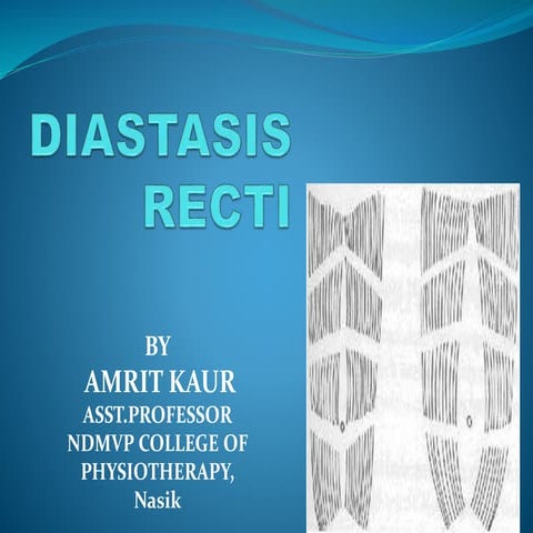 Diastasis recti | PPTX