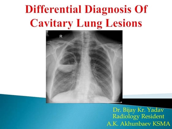 X Ray: Chest-Homogenous opacity | PPT