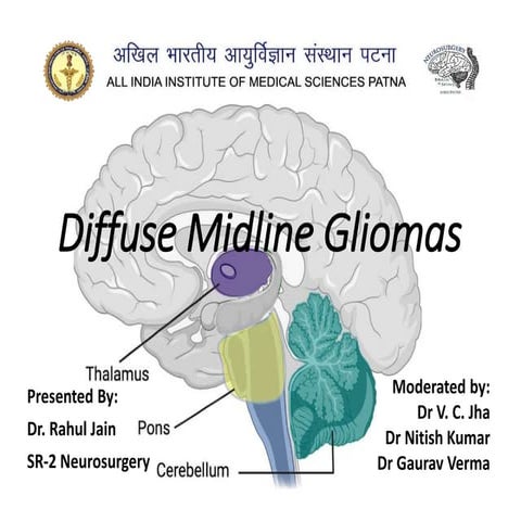 Brainstem Gliomas/ Diffuse Midline Gliomas/ Diffuse Pontine Gliomas.pptx