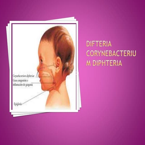 Difteria | PPTX