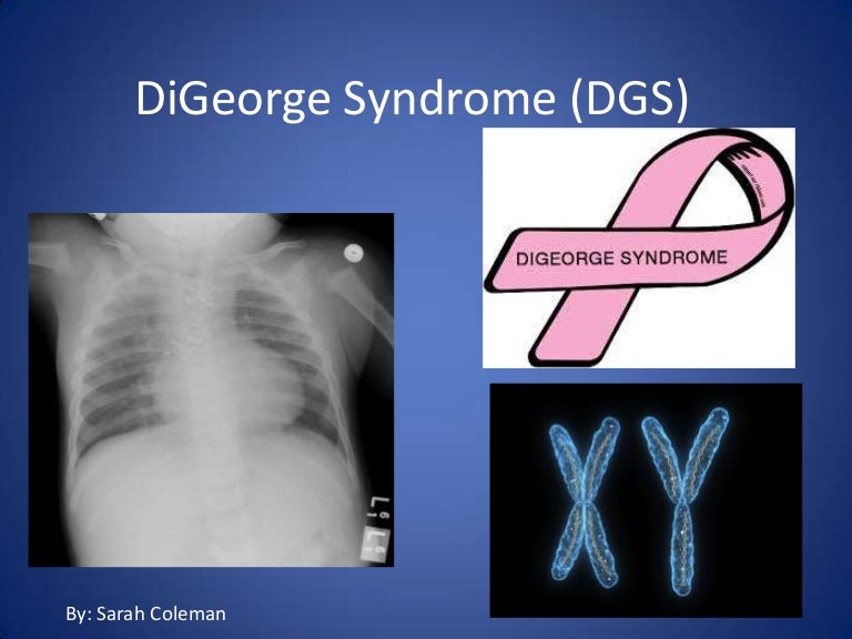 Di george syndrome (dgs)