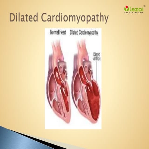 Dilated cardiomyopathy | PPTX