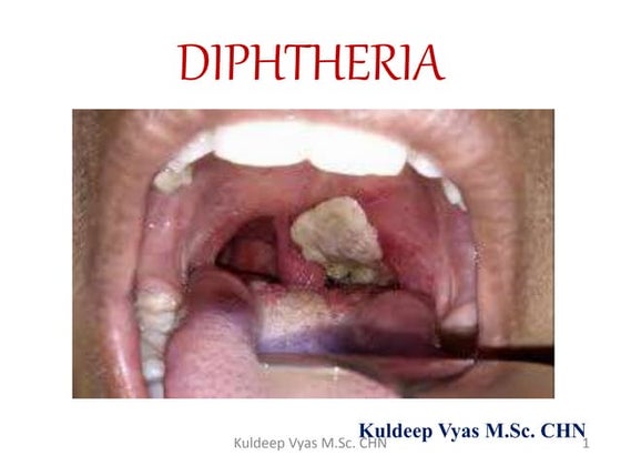 Diphtheria | PPT