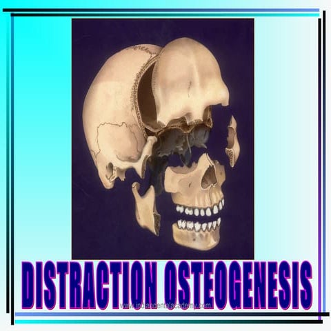Distraction osteogenesis final | PPT