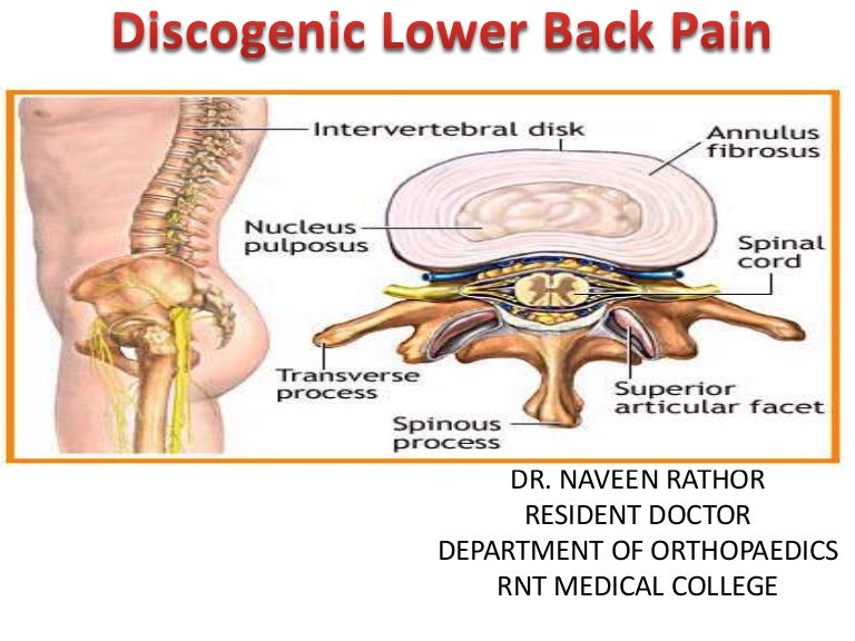 Discogenic lower backache by DR.NAVEEN RATHOR