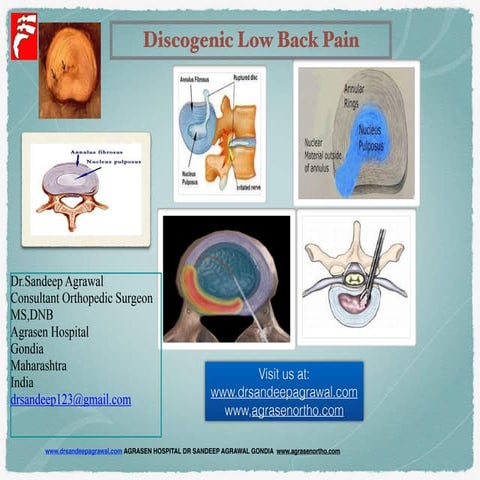 Discogenic low back pain Treatment agrasen hospital gondia vidarbha dr ...