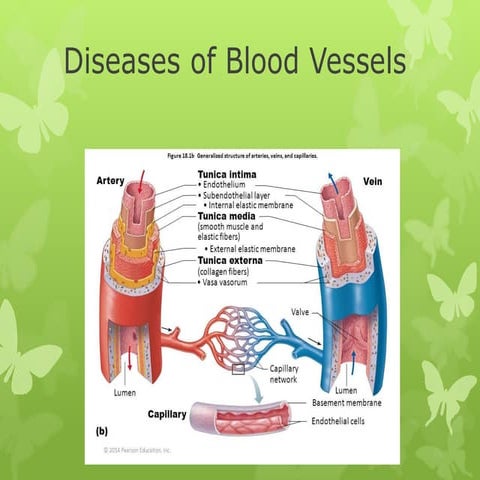 Diseases of blood vessels | PPTX