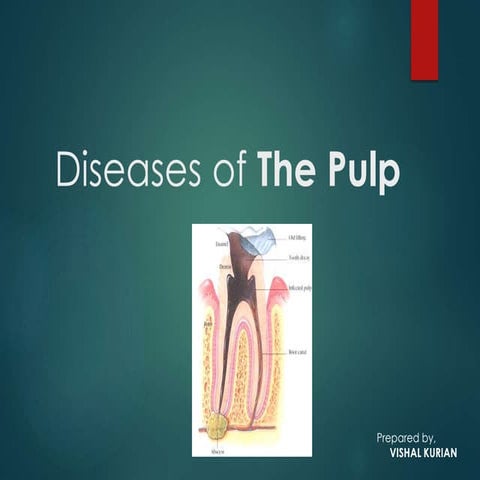Diseases of pulp | PPTX