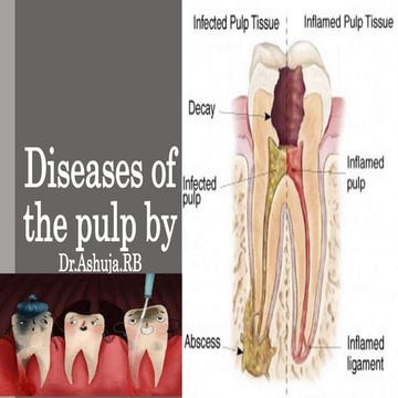 Diseases of pulp for ugs | PPTX